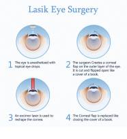 What Does LASIK Eye Surgery Feel Like Optilase Laser Eye Surgery